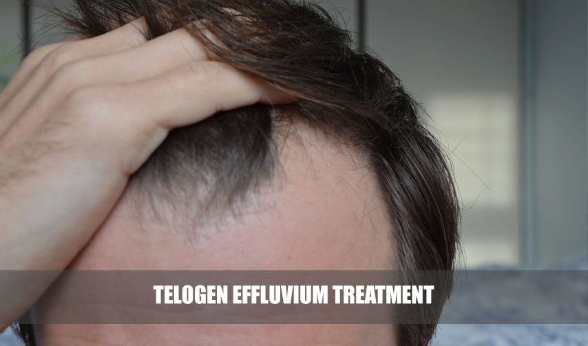 Telogen Effluvium Causes Regrowth And Treatment In Thane
